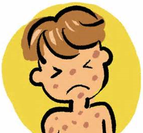 Impetigo (School sores)
